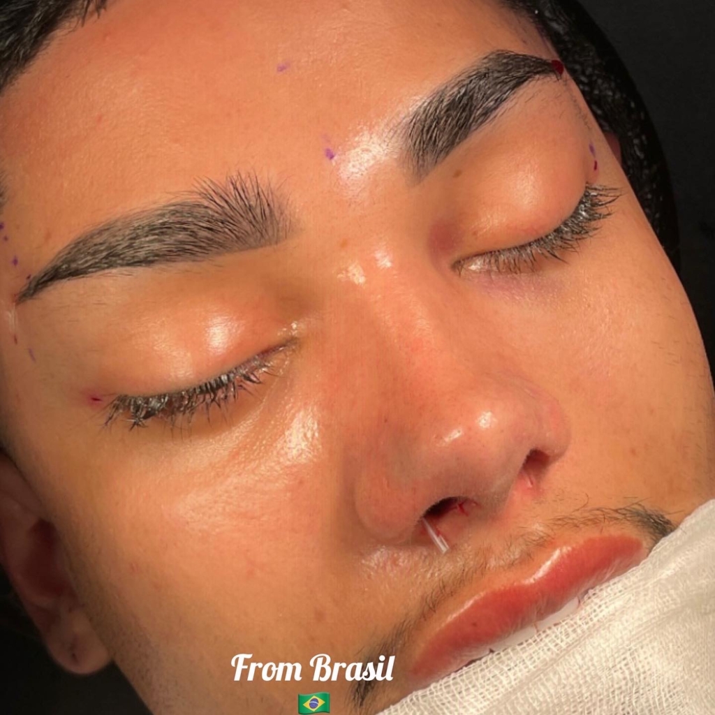 Fox Eye Surgery (Full Guide) - Op. Dr. Mustafa Yazır